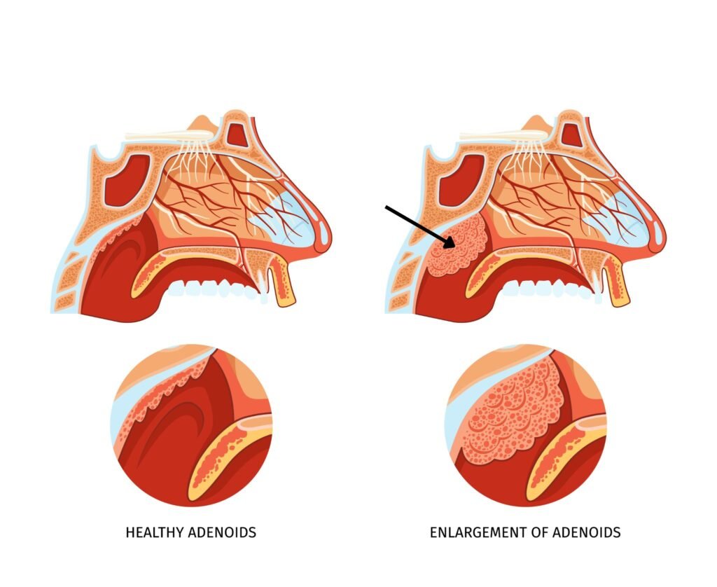 Adenoid Hypertrophy - Dr. Anshula Tayal Bansal